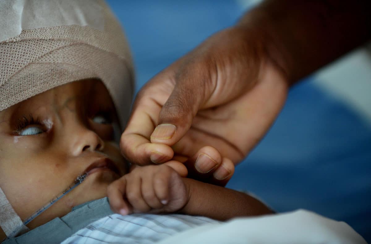 Roona Begum operation, Indian baby with swollen head defies the odds.