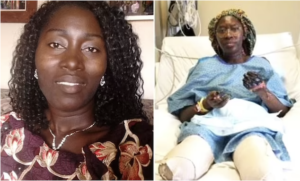 Jummai Nache has both legs amputated after contracting COVID-19