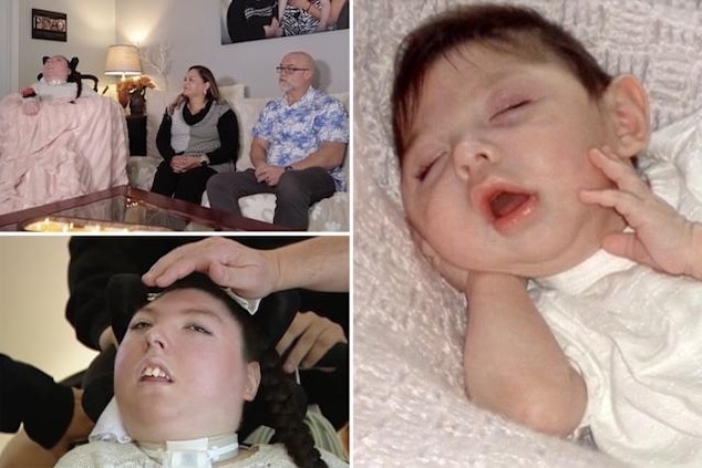 Nebraska 20 year old born with no brain survives on love & faith